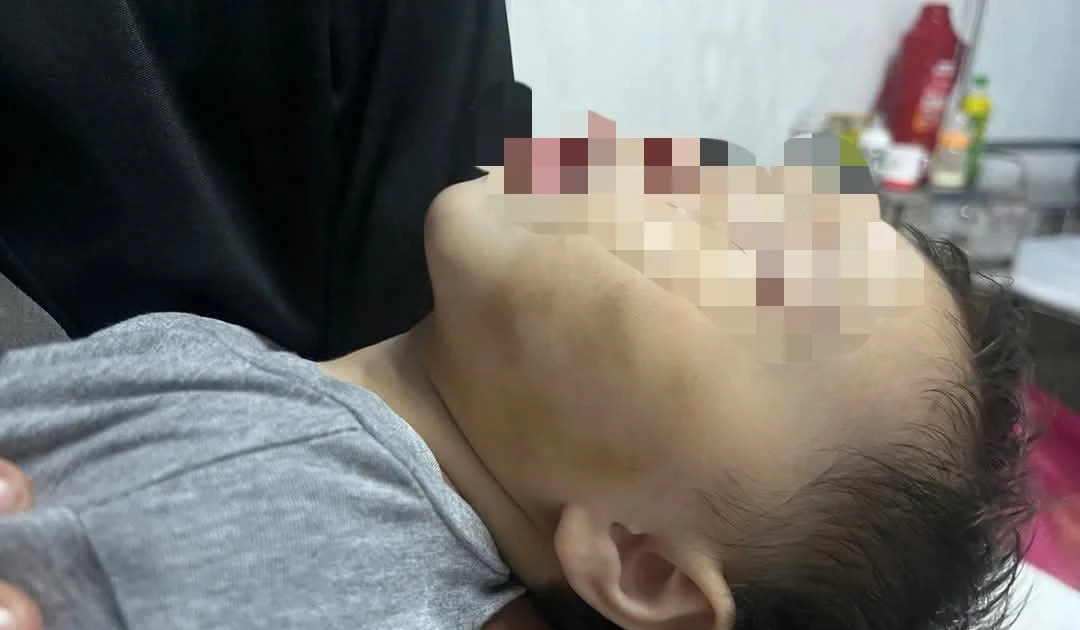 Xác minh thông tin bé gái 9 tháng tuổi bị bầm tím 2 bên má khi đi nhà trẻ | Báo Giáo dục và Thời ...